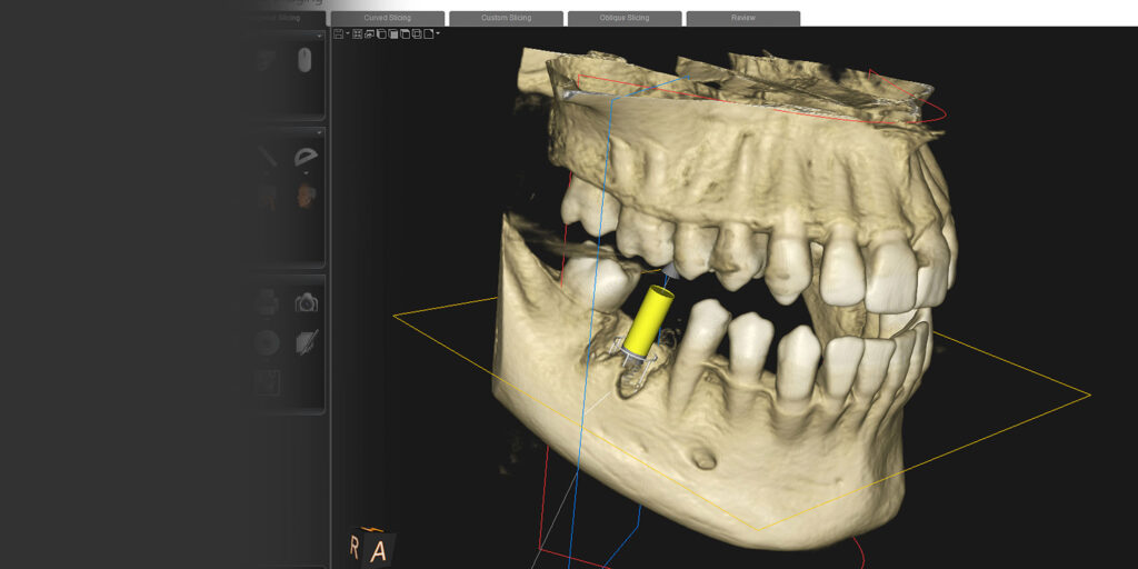 X-Guide Dynamic Implant Surgery | East Georgia Center for Oral & Facial ...